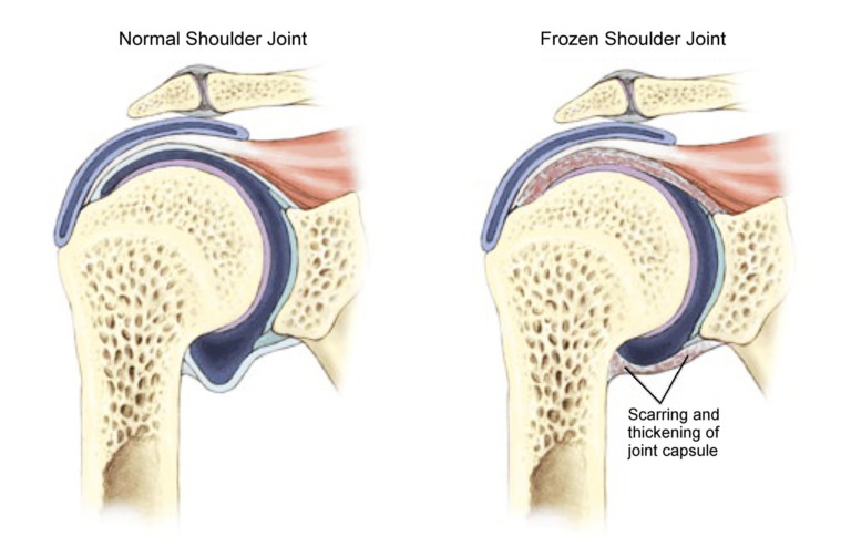 What Causes Frozen Shoulder, and the Most Effective Treatment