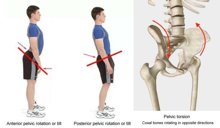 How to Fix Pelvic Torsion (Twisted Pelvis) With Clinical Somatics ...